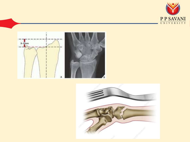 9. Forearm lower end fractures | PPT