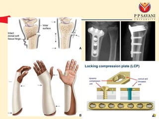 9. Forearm lower end fractures | PPT