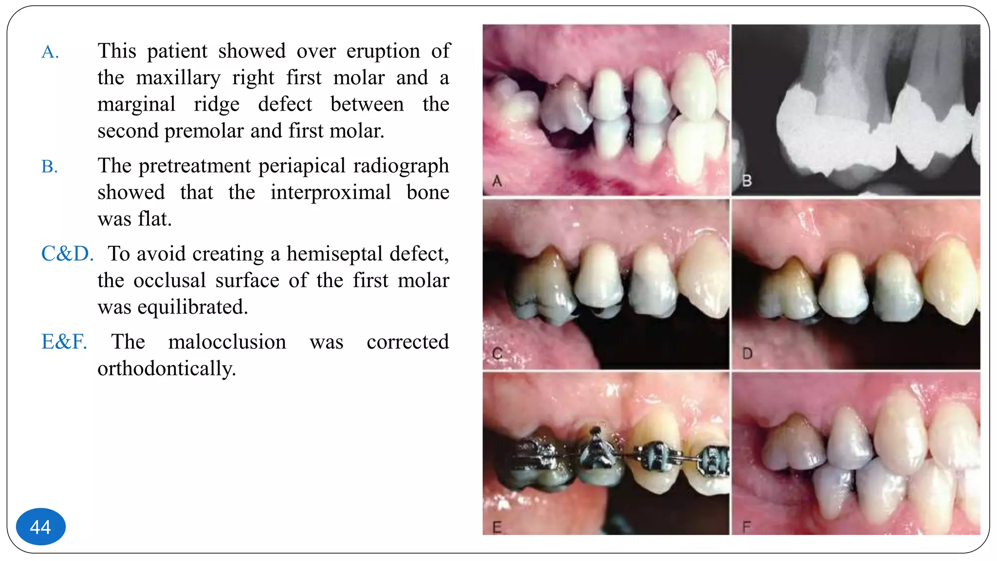 Perio-Ortho Interdisciplinary approch | PPTX