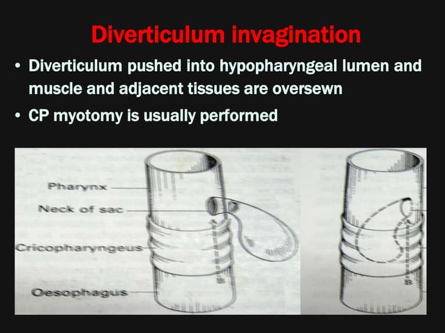 9. hypopharyngeal pouch and stylalgia | PPT