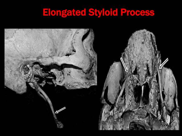 9. hypopharyngeal pouch and stylalgia | PPT