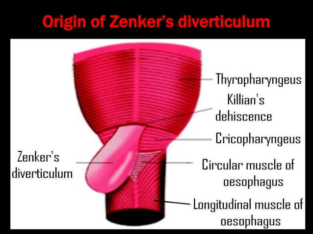 9. hypopharyngeal pouch and stylalgia | PPT
