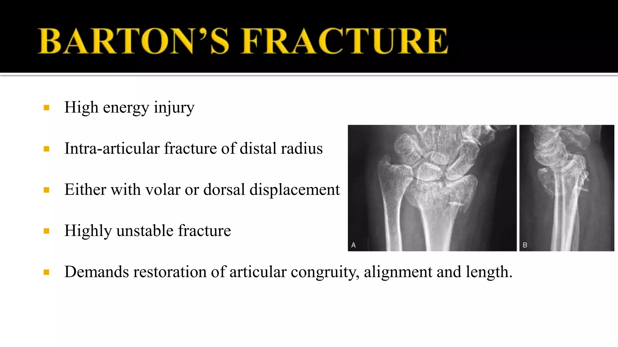 Distal radius fracture | PPTX
