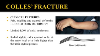 Colles Fracture Dinner Fork