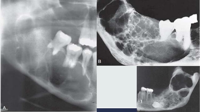 Radiographic Interpretation of Benign Tumors of the Jaws | PPTX