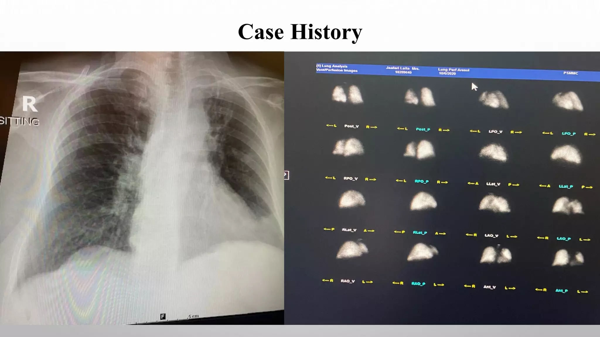Pulmonary Ventilation and Perfusion Scan | PDF