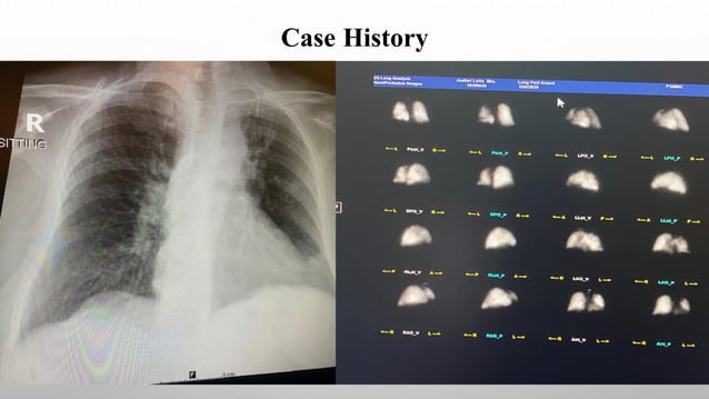 Pulmonary Ventilation and Perfusion Scan | PDF | Lung and Respiratory ...