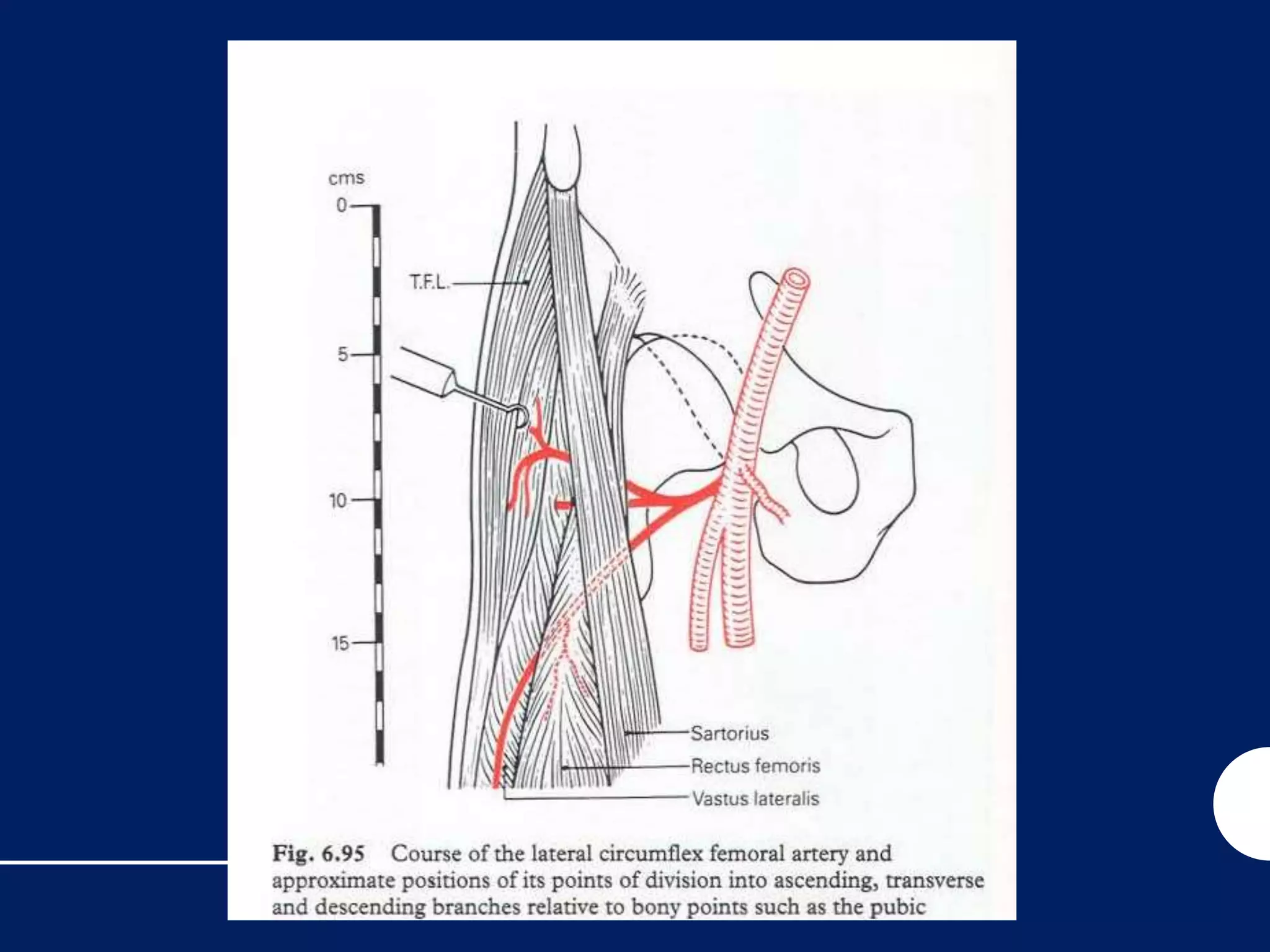 Antero Lateral thigh flap | PPTX
