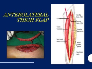 Antero Lateral thigh flap | PPTX
