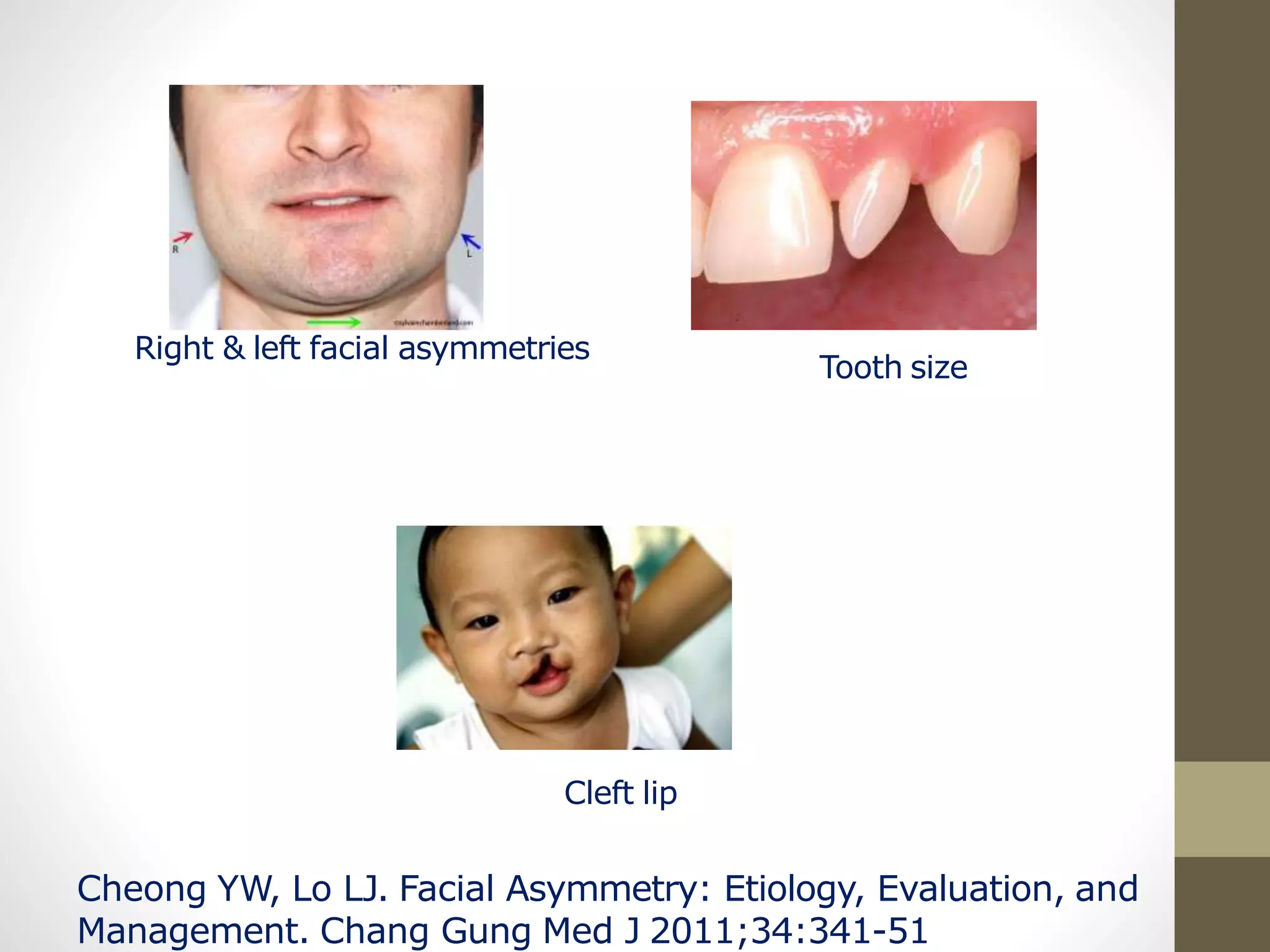 ETIOLOGY AND DIAGNOSIS OF FACIAL ASYMMETRY | PPTX