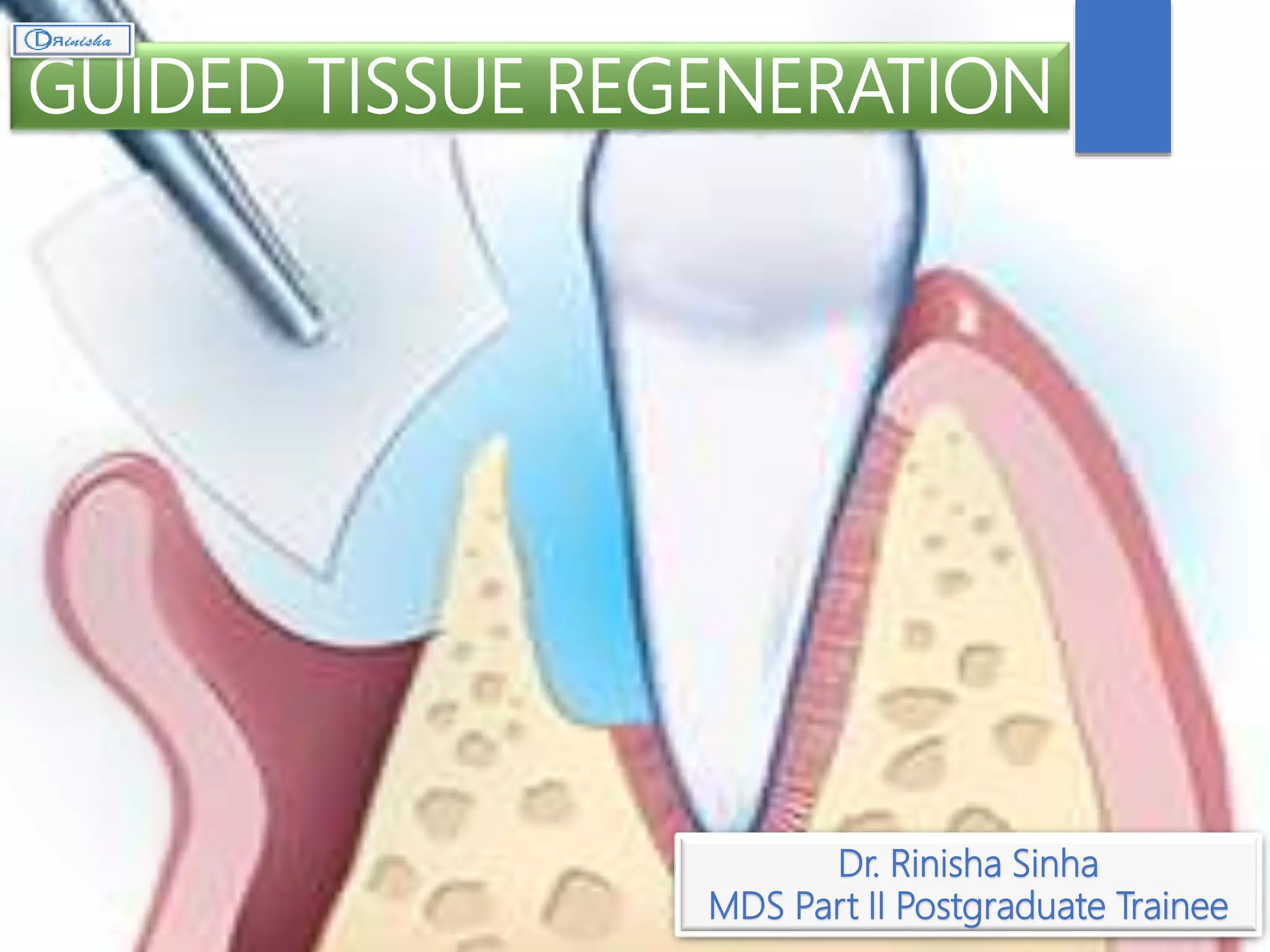 Guided Tissue Regeneration | PPTX