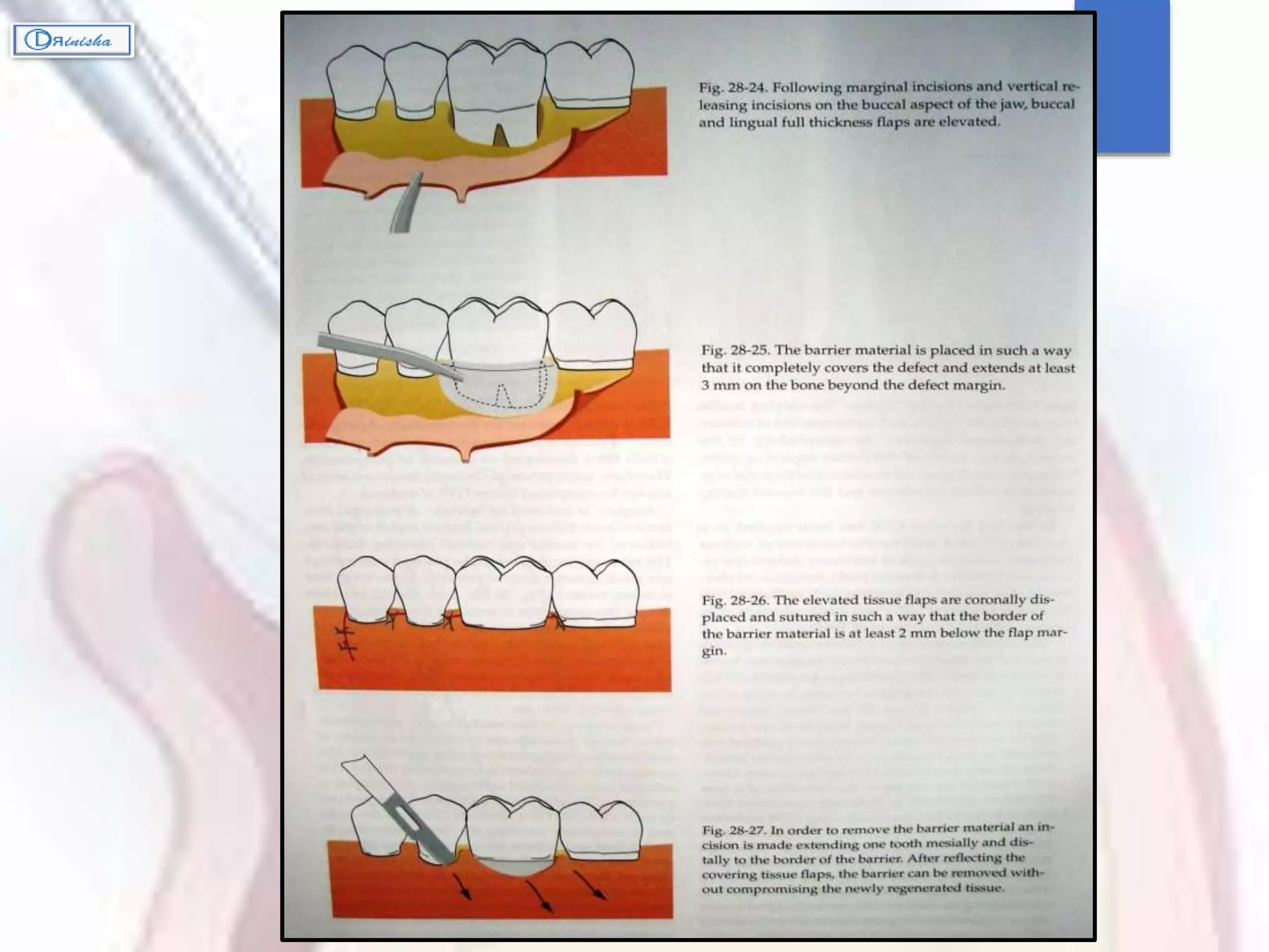 Guided Tissue Regeneration | PPTX