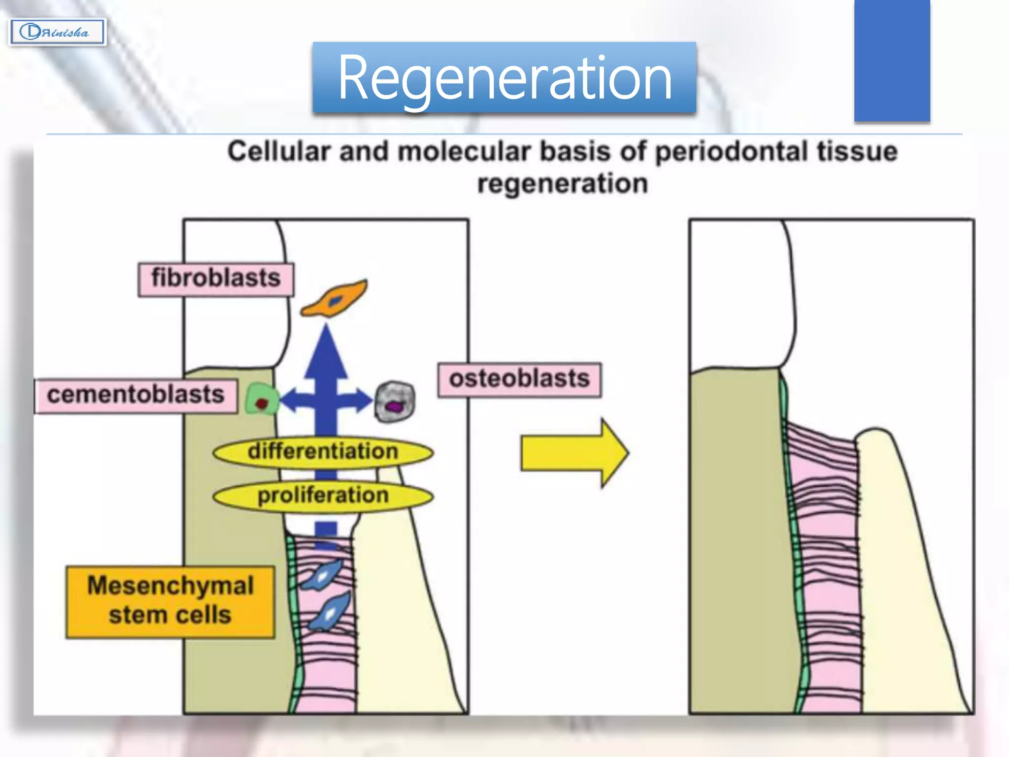 Guided Tissue Regeneration | PPTX