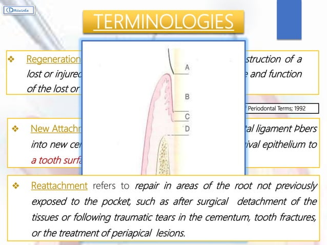 Guided Tissue Regeneration | PPTX