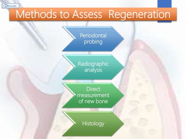 Guided Tissue Regeneration | PPTX