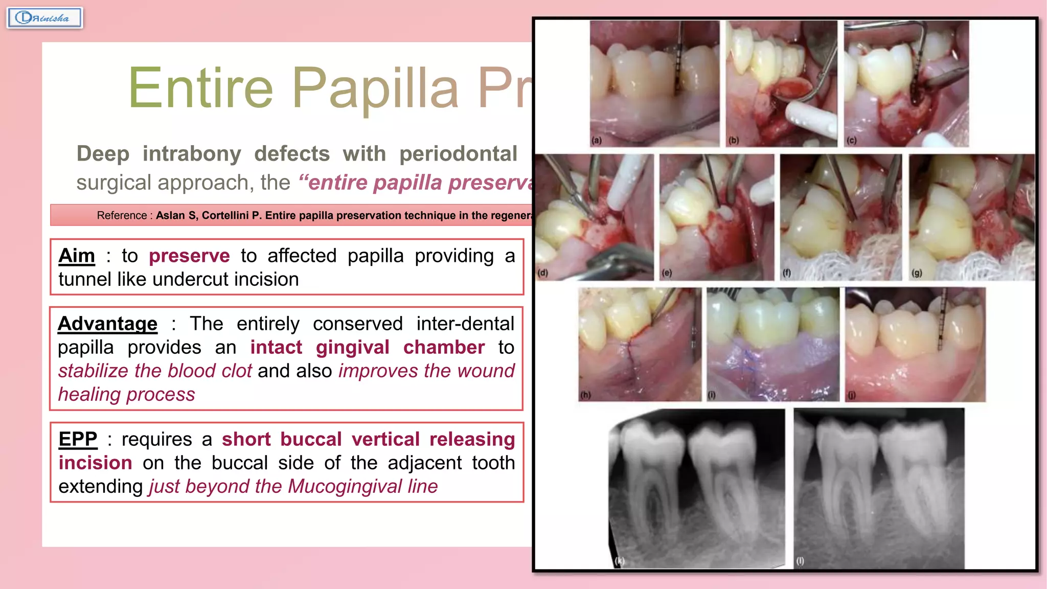 Papilla Preservation Techniques.pptx