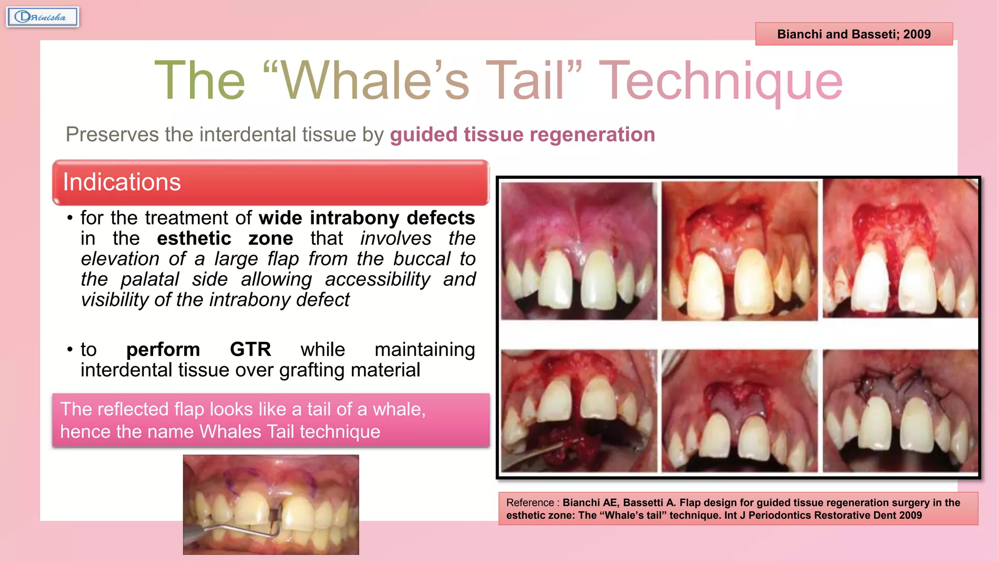 Papilla Preservation Techniques.pptx