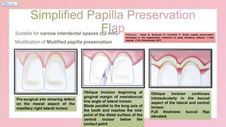 Papilla Preservation Techniques.pptx