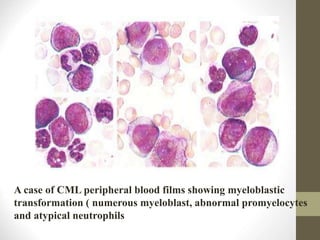 9. Chronic Myeloid Leukaemia.ppt | Blood Disorders | Diseases and Conditions