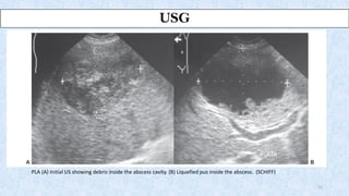 9.LIVER ABSCESS | PDF
