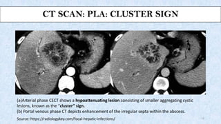 9.LIVER ABSCESS | PDF