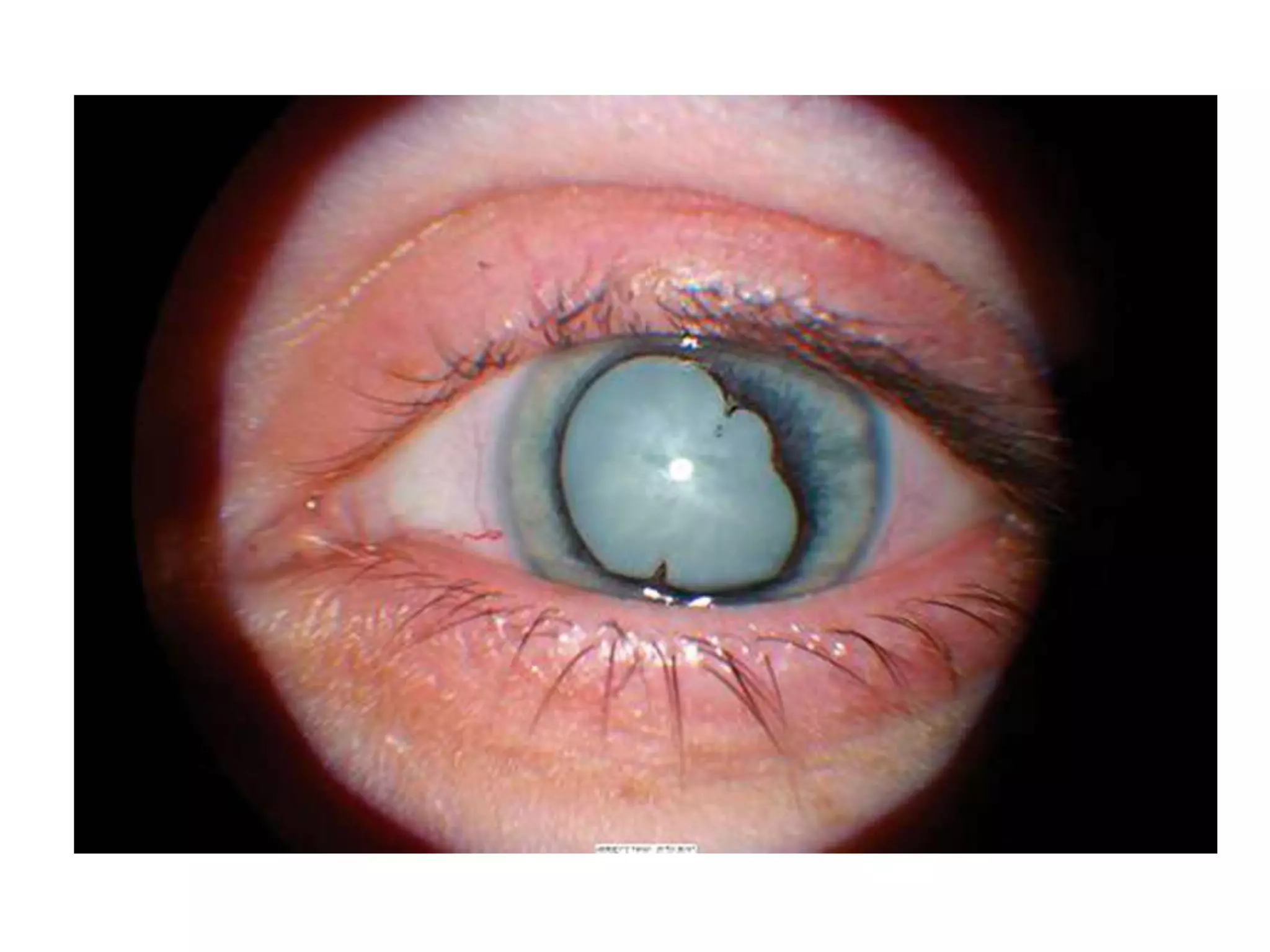 9. DISEASES OF THE LENS.ppt