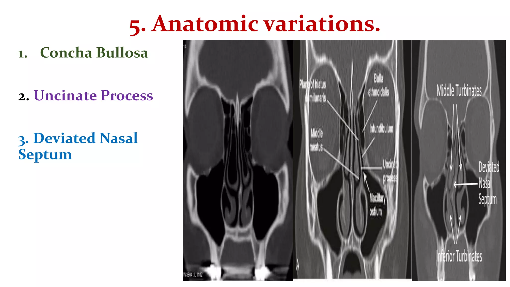 9. Anatomy of the Nose and Paranasal sinuses, Dr. Maxprince.pptx