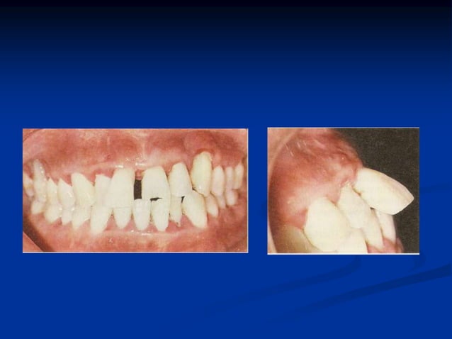 9.Tooth mobility.ppt | Dental Health | Diseases and Conditions