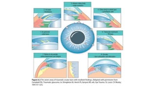 9. Glaucoma por Trauma Ocular.pptx OFTALMOLOGIA GLAUCOMA | PPTX