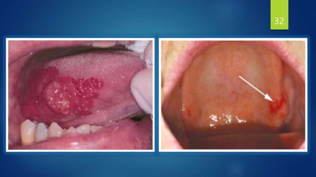 9. Oral cavity cancer presentation Part 1.pptx