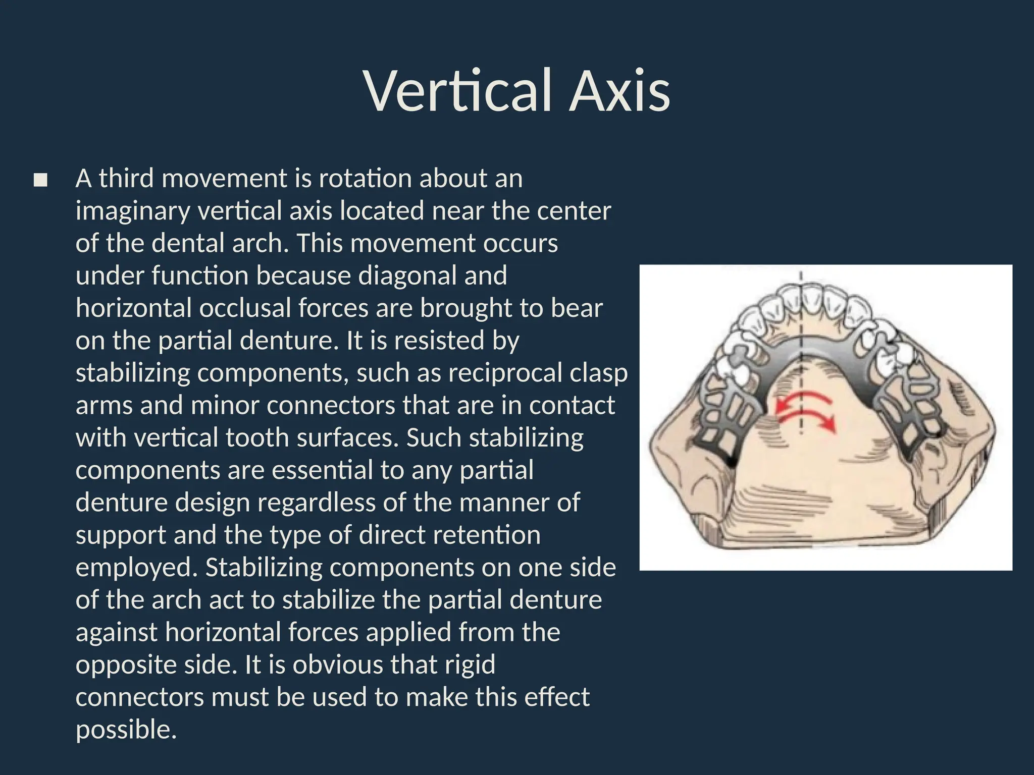 Indirect retainer in removable partial denture | PPTX