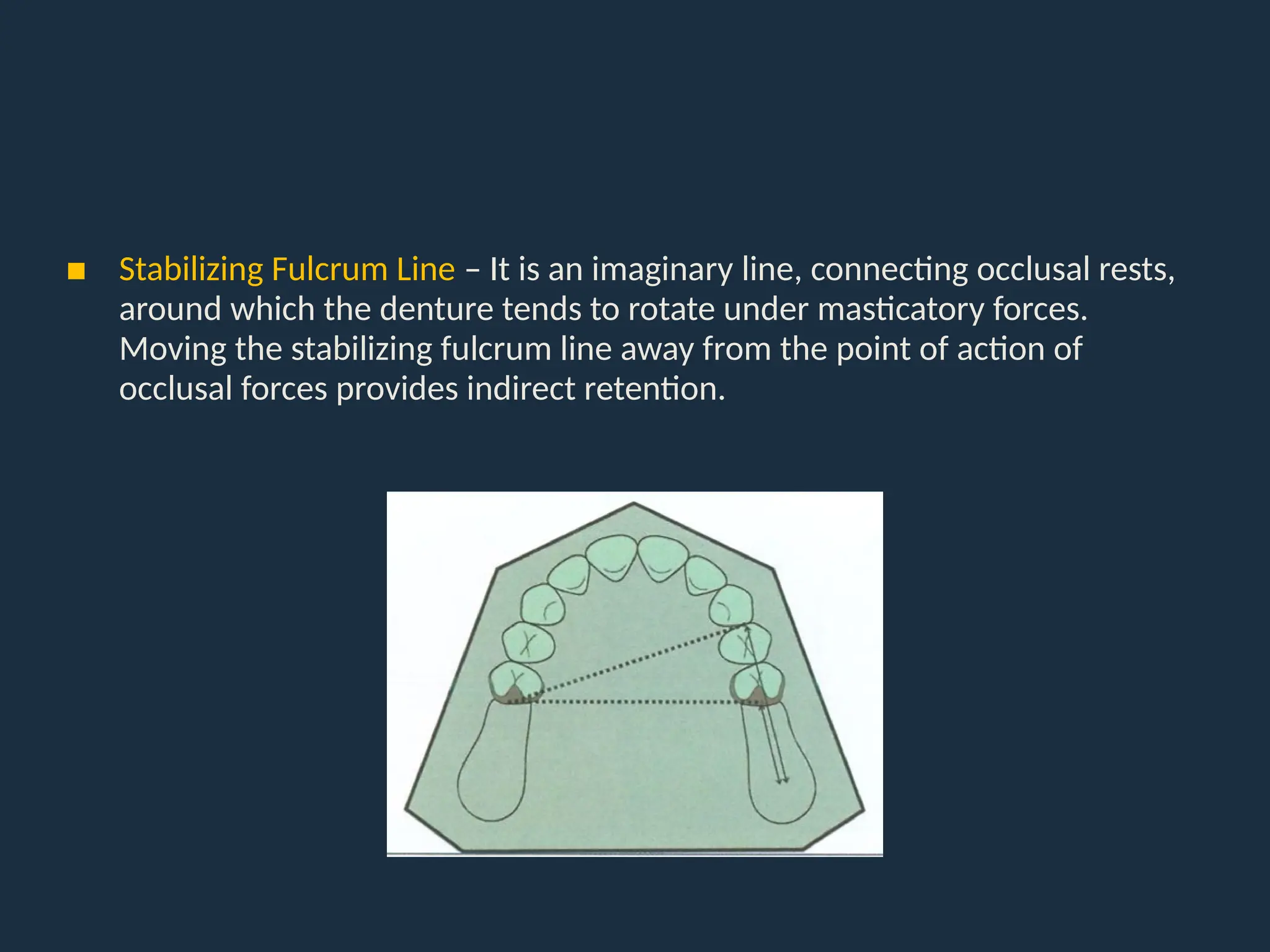 Indirect retainer in removable partial denture | PPTX