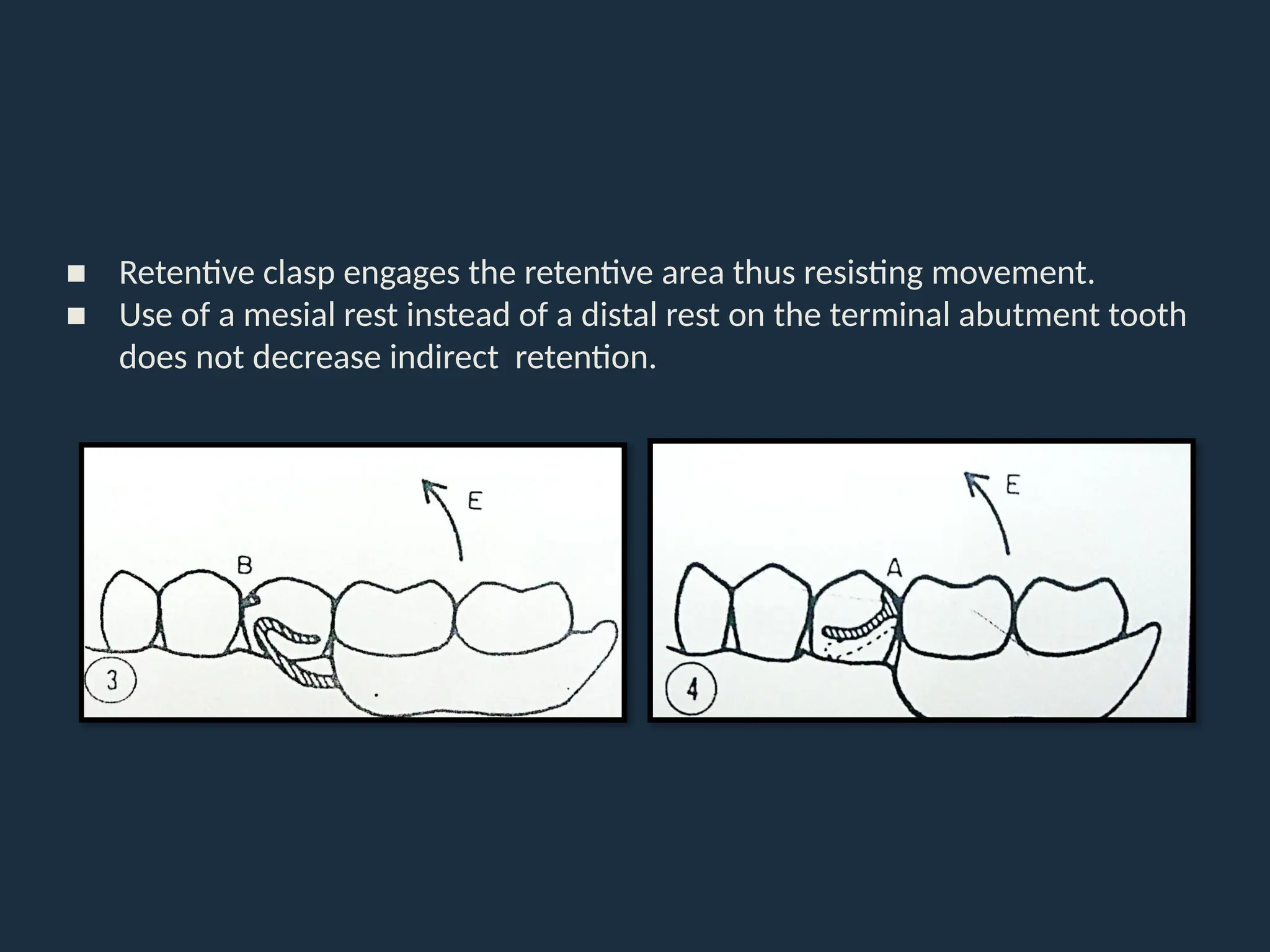 Indirect retainer in removable partial denture | PPTX