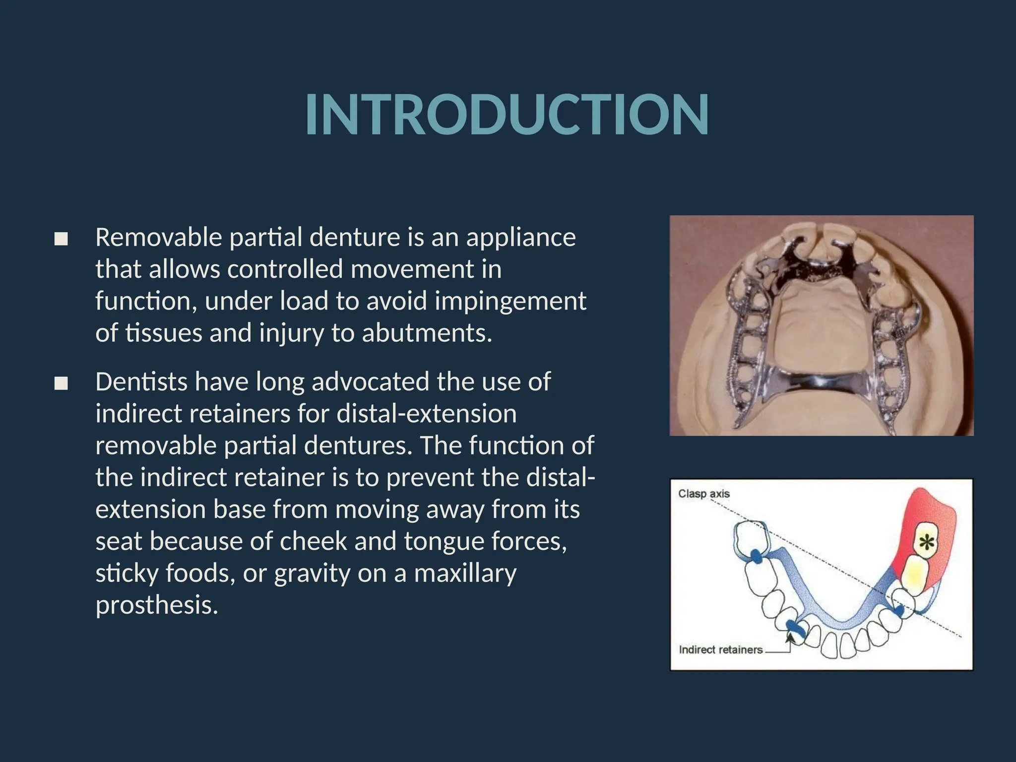 Indirect retainer in removable partial denture | PPTX