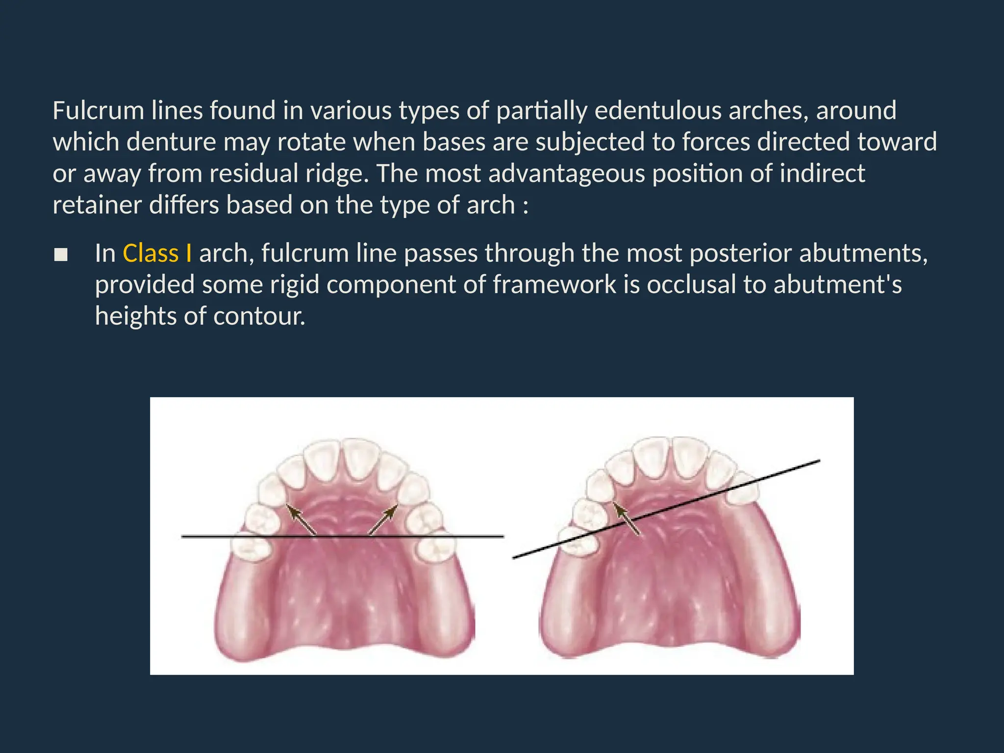 Indirect retainer in removable partial denture | PPTX