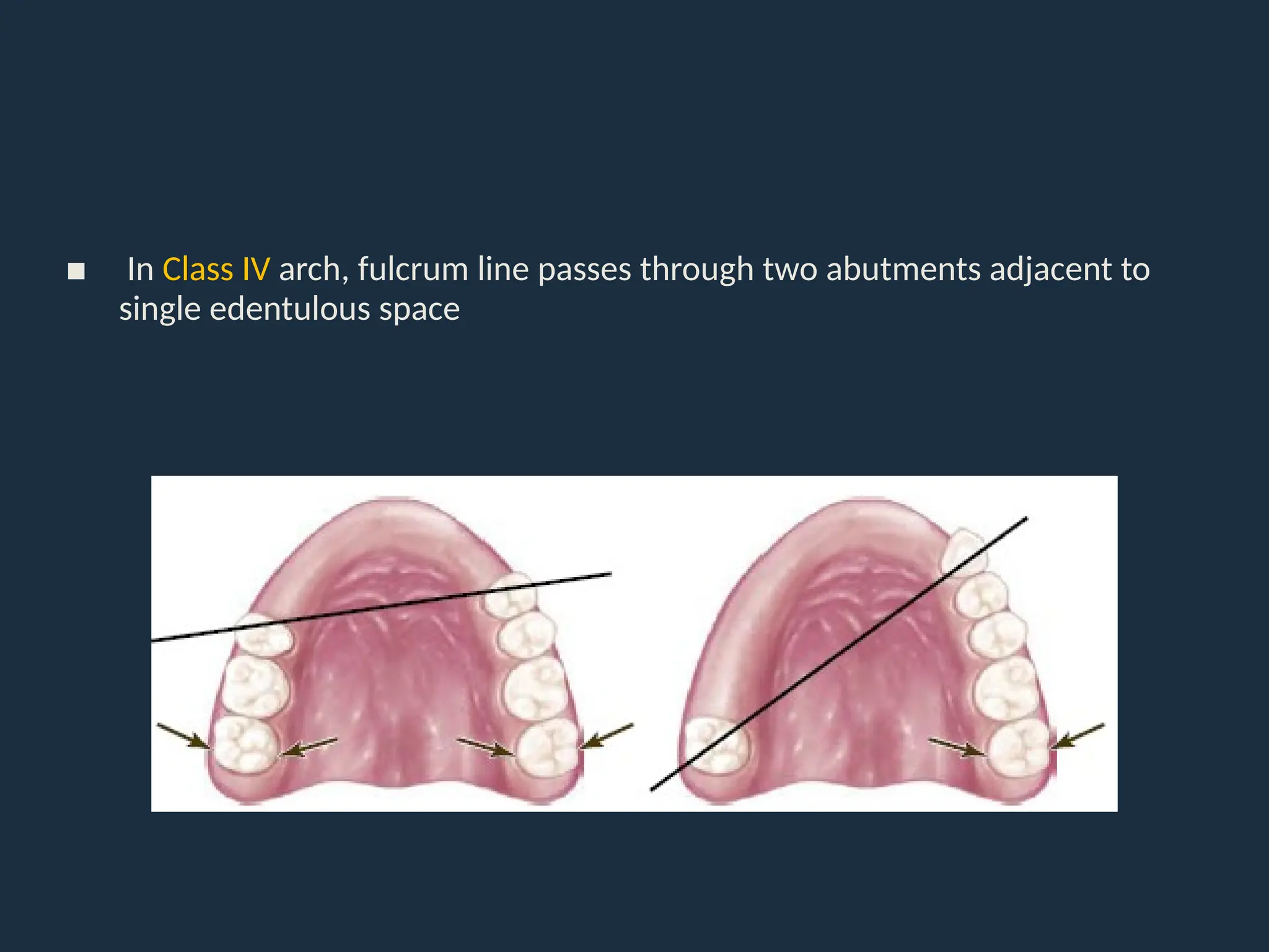 Indirect retainer in removable partial denture | PPTX