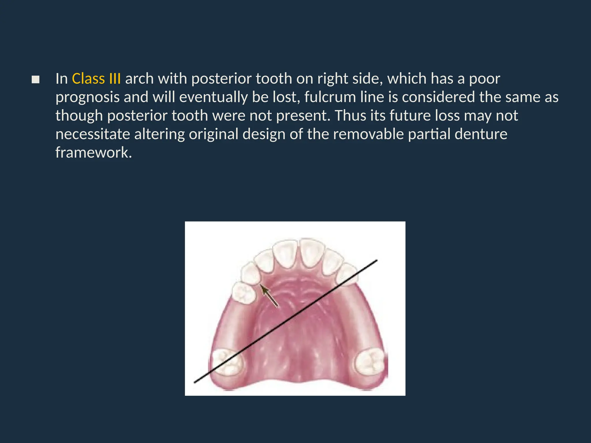 Indirect retainer in removable partial denture | PPTX