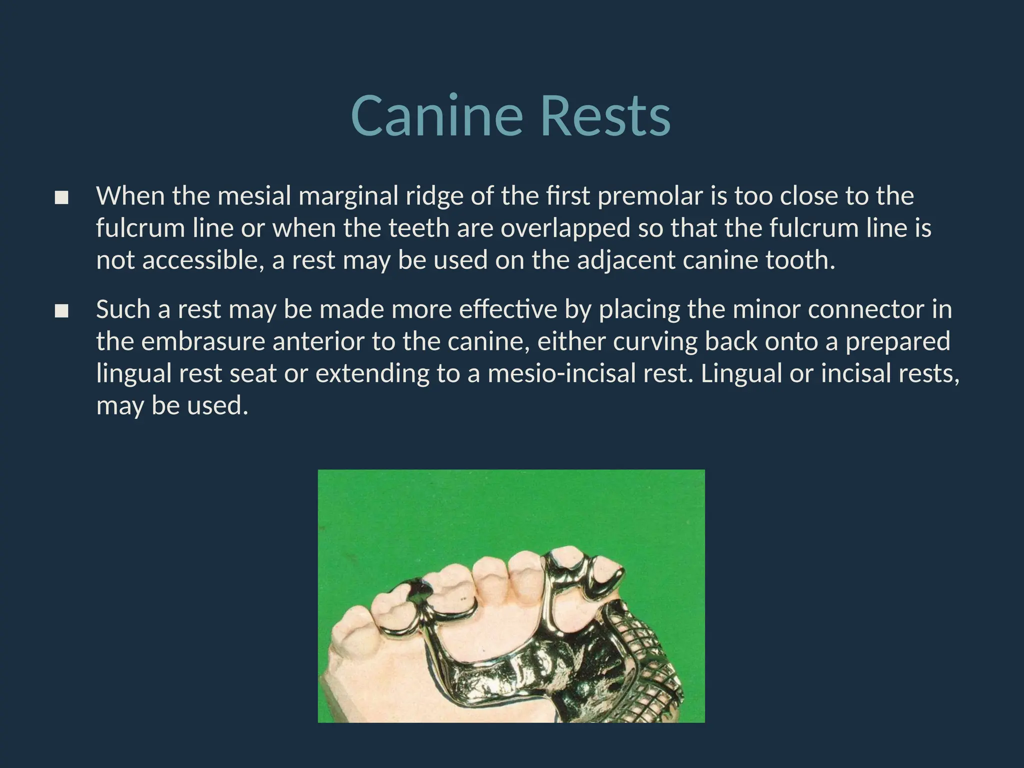 Indirect retainer in removable partial denture | PPTX