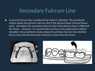 Indirect retainer in removable partial denture | PPTX