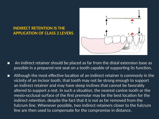 Indirect retainer in removable partial denture | PPTX