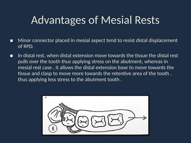 Indirect retainer in removable partial denture | PPTX