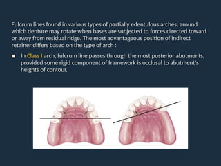 Indirect retainer in removable partial denture | PPTX