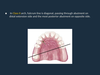 Indirect retainer in removable partial denture | PPTX