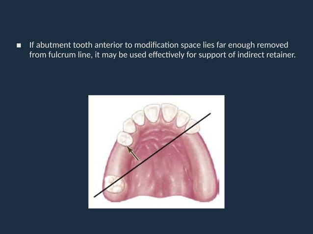 Indirect retainer in removable partial denture | PPTX