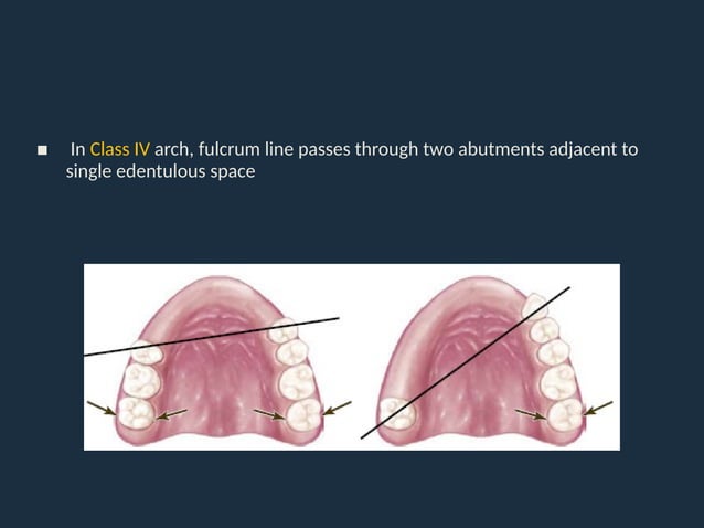 Indirect retainer in removable partial denture | PPTX