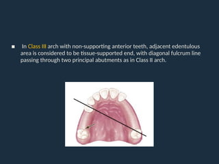 Indirect retainer in removable partial denture | PPTX