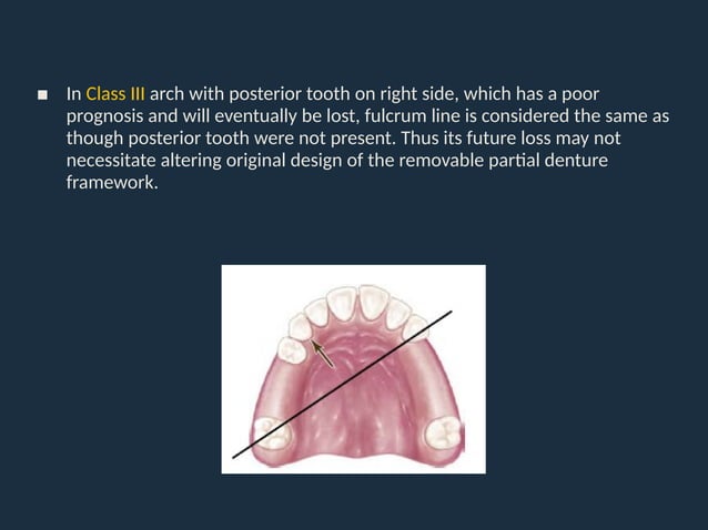 Indirect retainer in removable partial denture | PPTX
