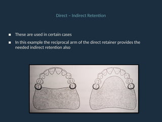 Indirect retainer in removable partial denture | PPTX