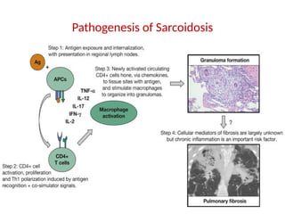 Sarcoidosis Respiratory Disease Slide Note | PPT