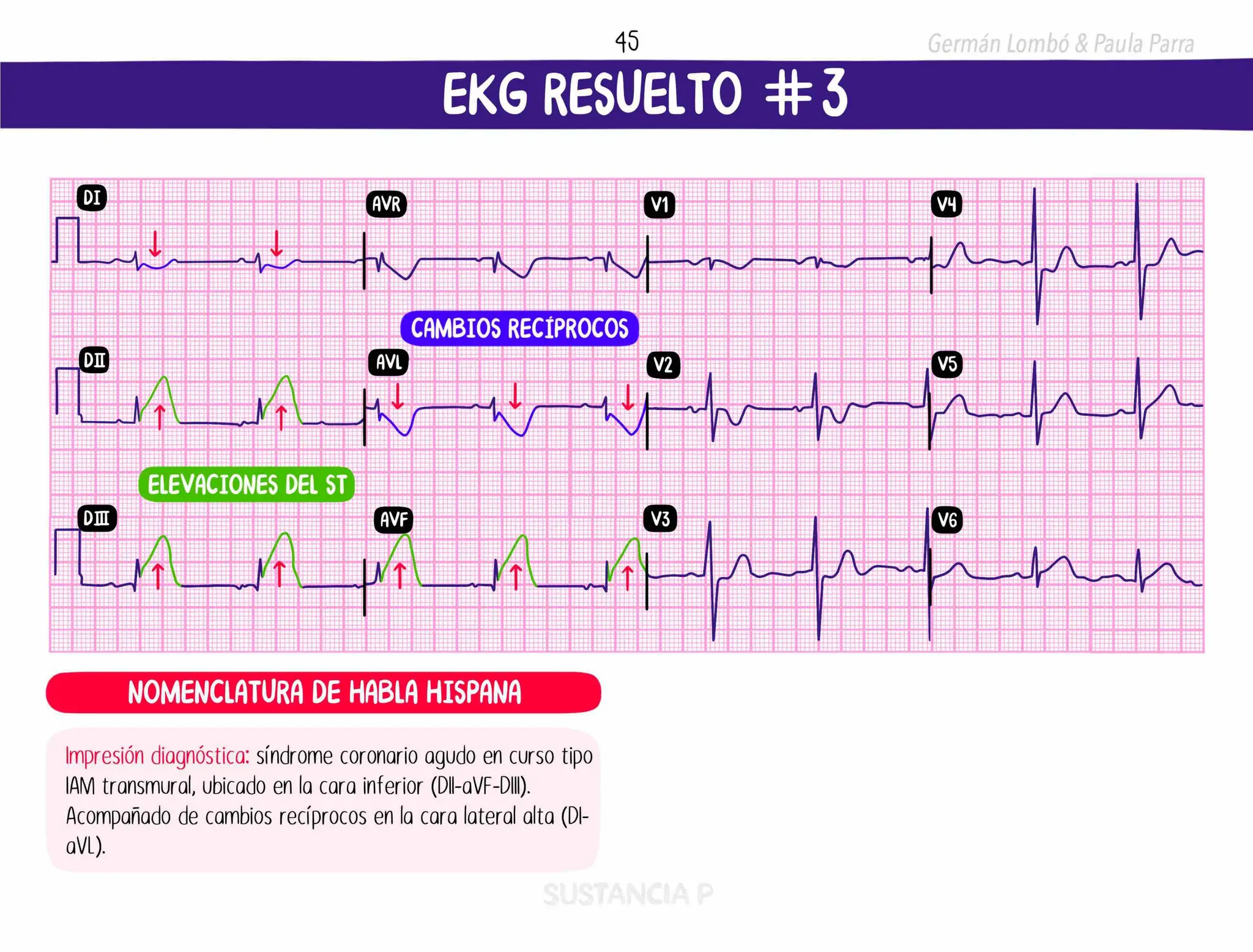 EKG Patológico y contenido básico del electrocardiograma | PPT